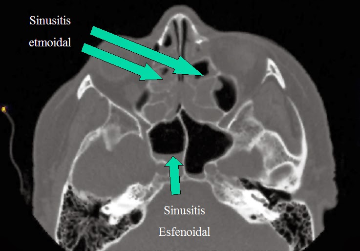 Alteraciones y enfermedades : Sinusitis