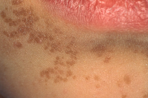 Types of warts | All About Warts