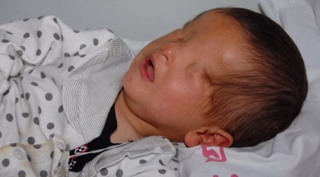 Baby Born Without Eyes
