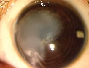 Eye Case of the Week: A Strange Growth 'in' the Cornea