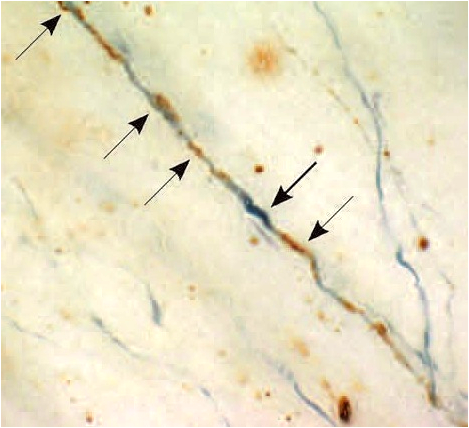 NeuroAnatomía Dr. William Ganem: Enfermedad de Parkinson