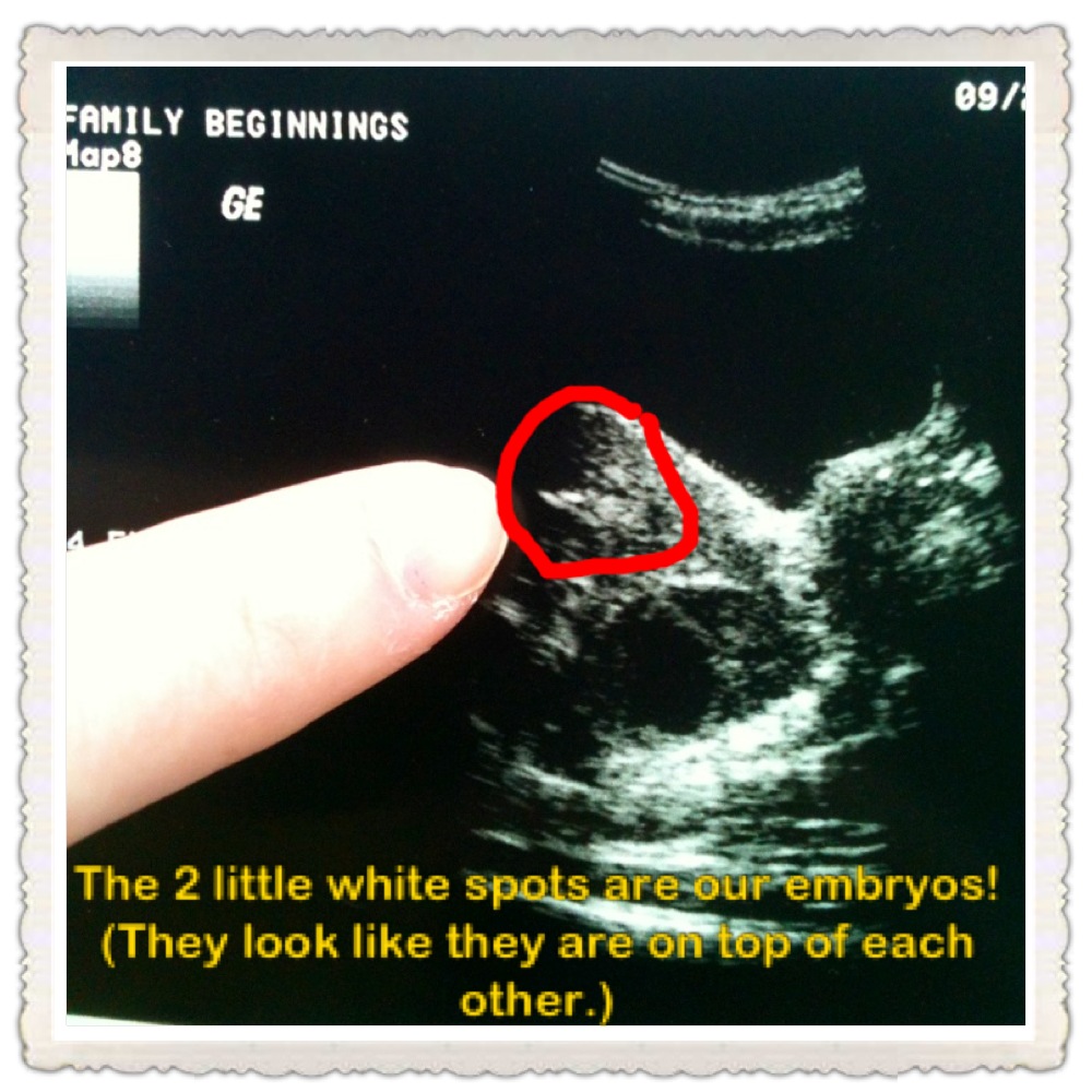 Going from 2 to 3: Embryo Transfer