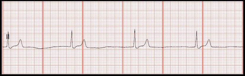 Practice EKG Rhythm Strips 143: Various Hyperkalemia