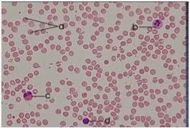 Atlas de Hematología : Anormalidades de los monocitos.