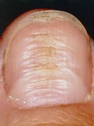 TIPS by ASK Cosmetics Blog: Are ridged nails getting in the way of your ...