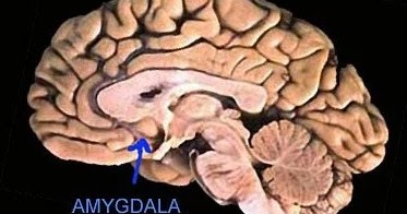 Blue Retro: Amygdala Tumor
