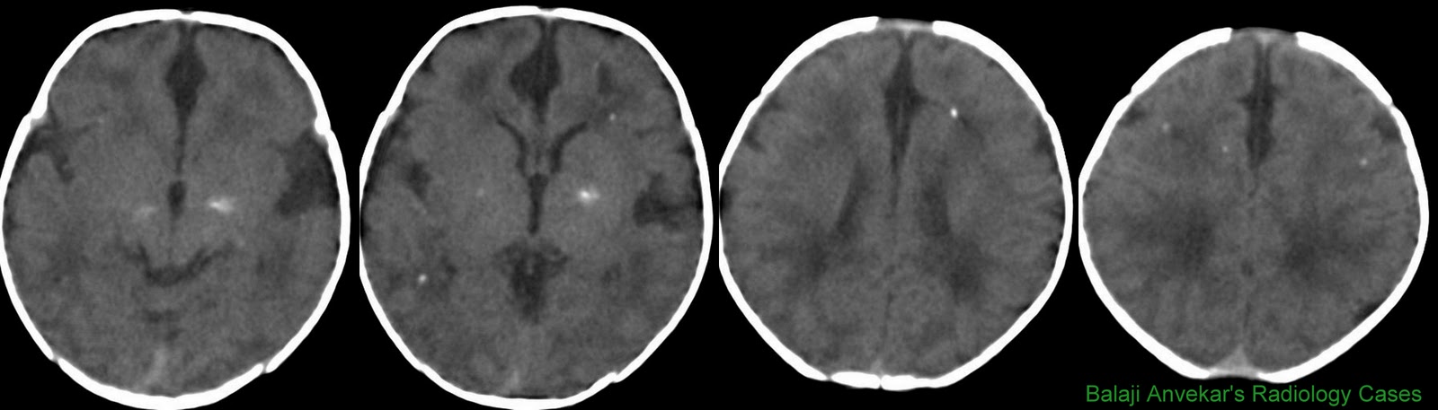 Dr Balaji Anvekars Neuroradiology Cases Intracranial Calcifications