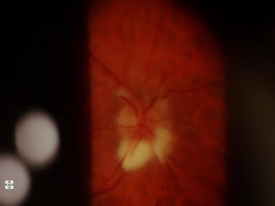 Sonoran Desert Eye Center: MYELINATED NERVE FIBERS