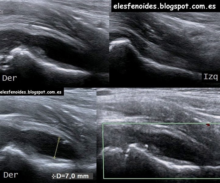 El esfenoides: Sinovitis transitoria de cadera. 2 imágenes 1 caso.