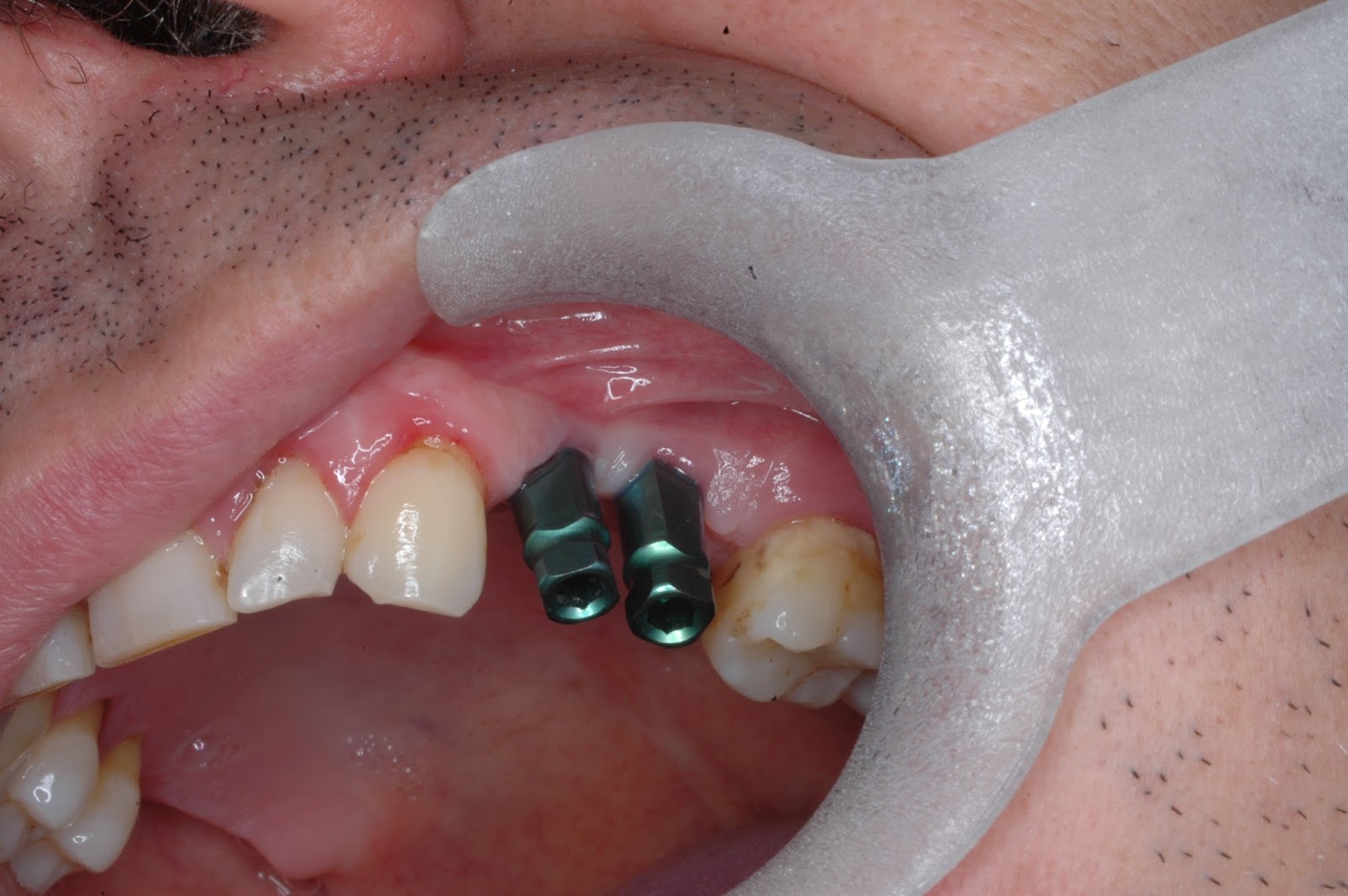 ODONTOLOGÍA: TOMA DE IMPRESIÓN DE LOS IMPLANTES CON CUBETA ESTÁNDAR