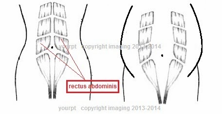 Your Physical Therapy: Diastasis Recti Test