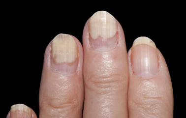 Wellness Lab Health Info: Fingernails: 5 Signs That Point to Bigger ...