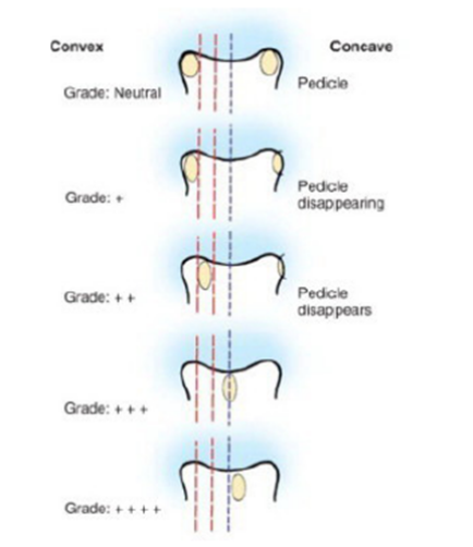 Orthopaedi dan Traumatologi: SKOLIOSIS IDIOPATIK