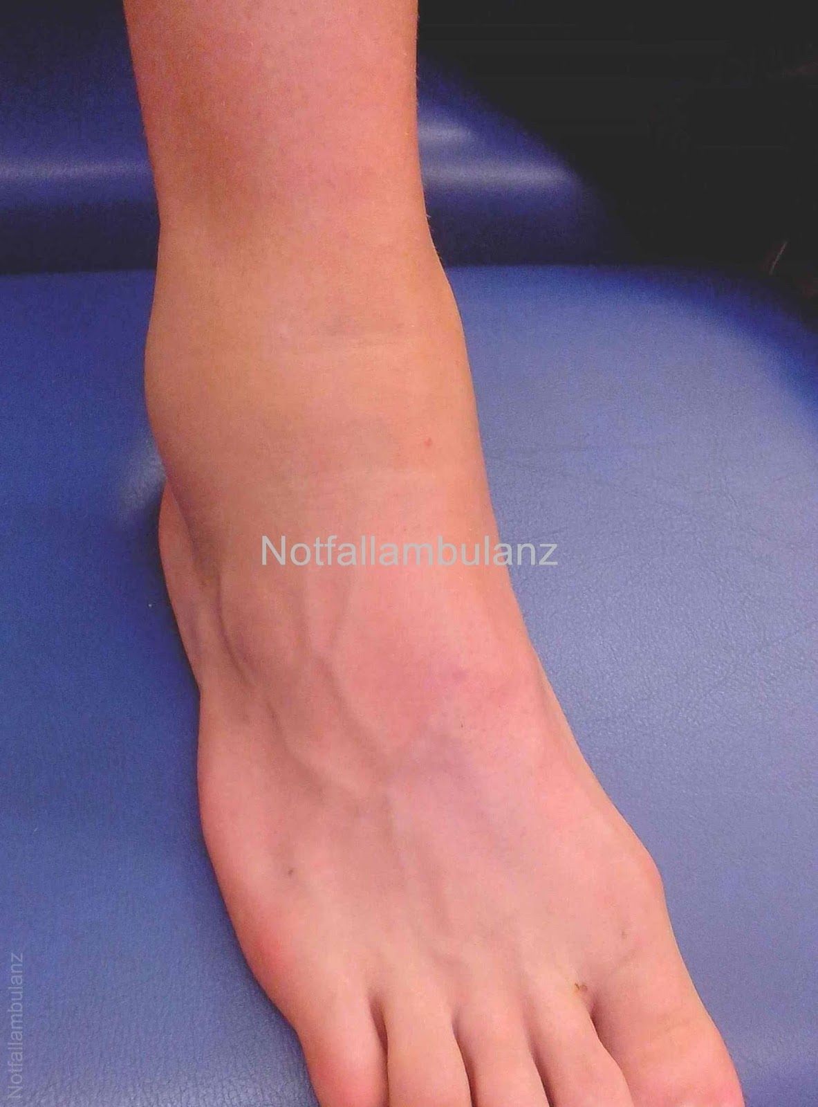 Brennpunkt Notaufnahme: Fall 16: Kindliche Distorsion des Sprunggelenkes