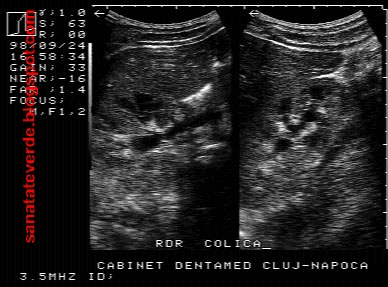 ecografie imagini medicina renal Renal nativ litiaza | Terapii ...