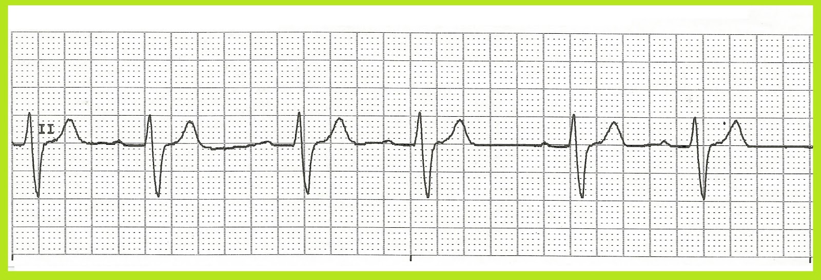 Characteristics of Sinus Rhythms