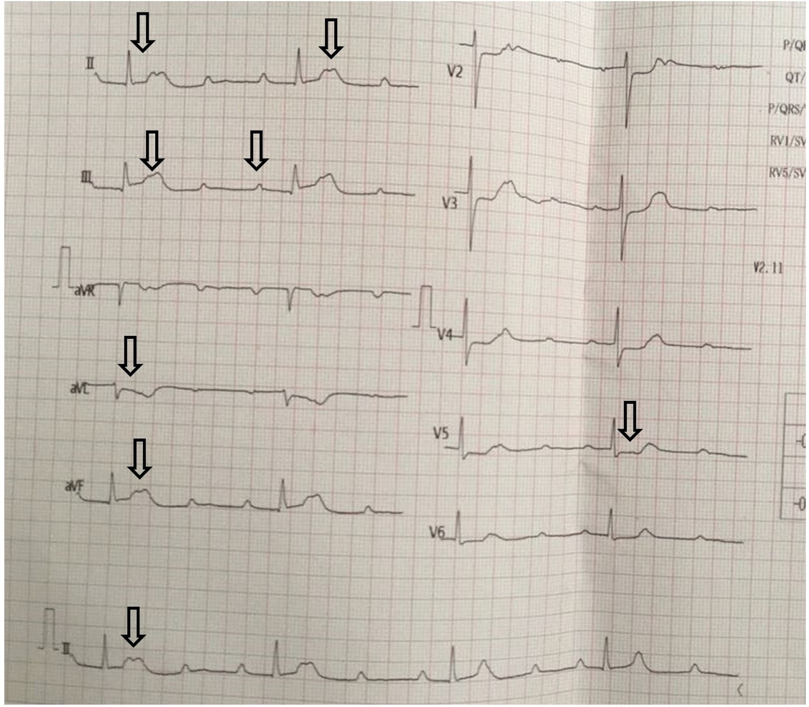 Cardiology window: Inferior wall myocardial infarction with variable block
