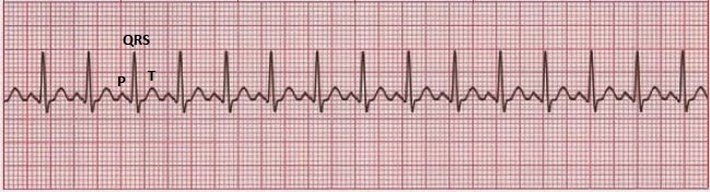 Cara cepat membaca Elektrokardiogram (EKG) | SholehShare