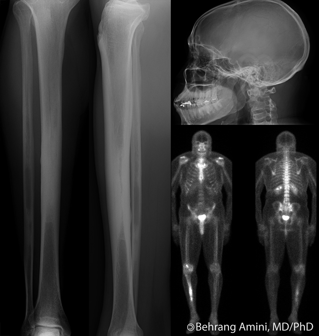 Roentgen Ray Reader: Diaphyseal Dysplasias