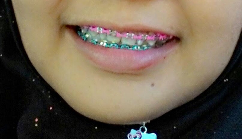 My Braces Elicy
