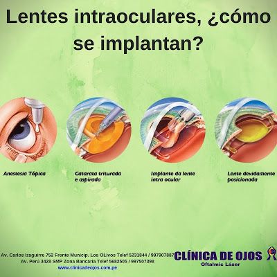 Clínica de Ojos Oftalmic Láser: Lentes intraoculares, ¿cómo se implantan?