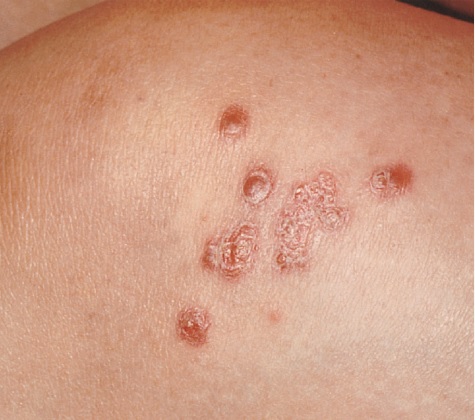 [STDs] Atlas of Reactive Arthritis | Free Medical Atlas