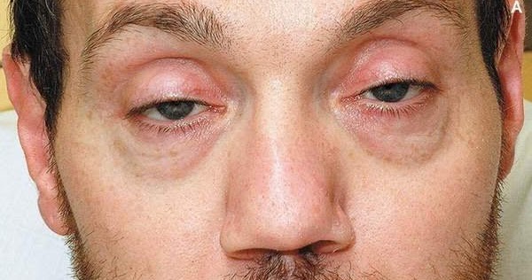 BIOMAGNETISMO ANTOFAGASTA -CHILE: Botulismo