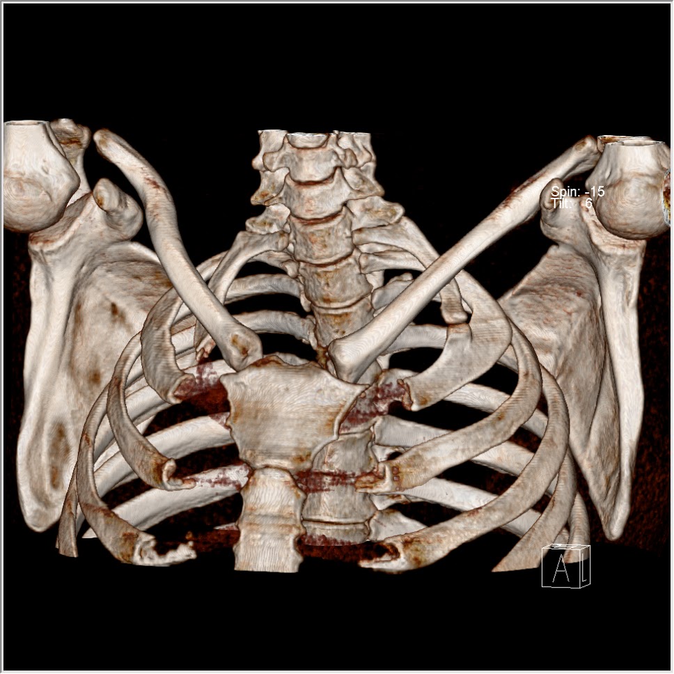 cervical rib with accessory articulation | The Third Eye - Radiology site