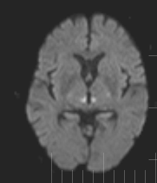 Artery of Percheron Infarction-MRI - Sumer's Radiology Blog