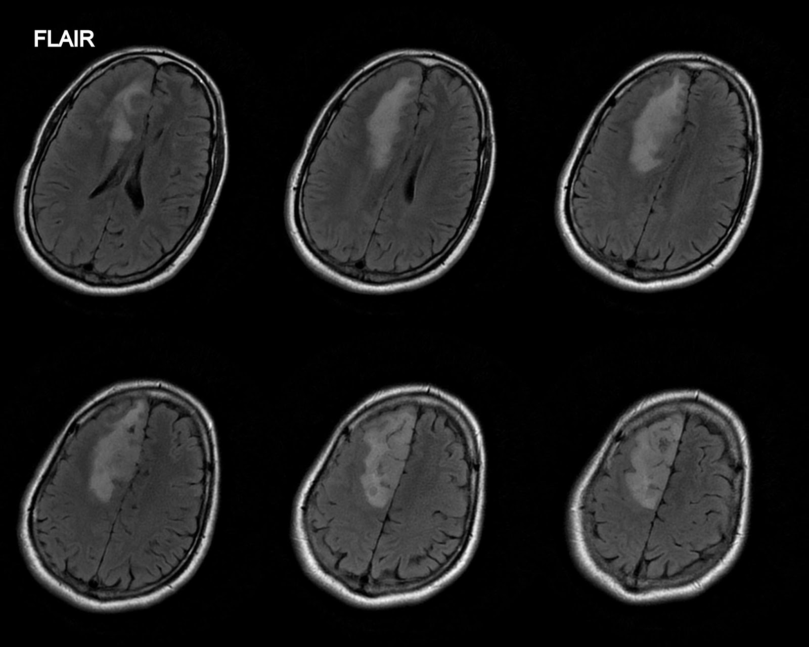 Dr Balaji Anvekar FRCR: Frontal lobe SOL on MRI