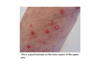 Consultations in Dermatology: Pityriasis Lichenoides PLEVA