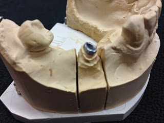 Zahnmedizin und Technik: Die Zirkon Krone oder VMK Krone