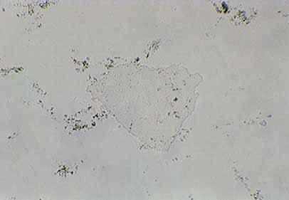 [Haematology] Microscopic Examination of Urinary Sediment - Crystals ...