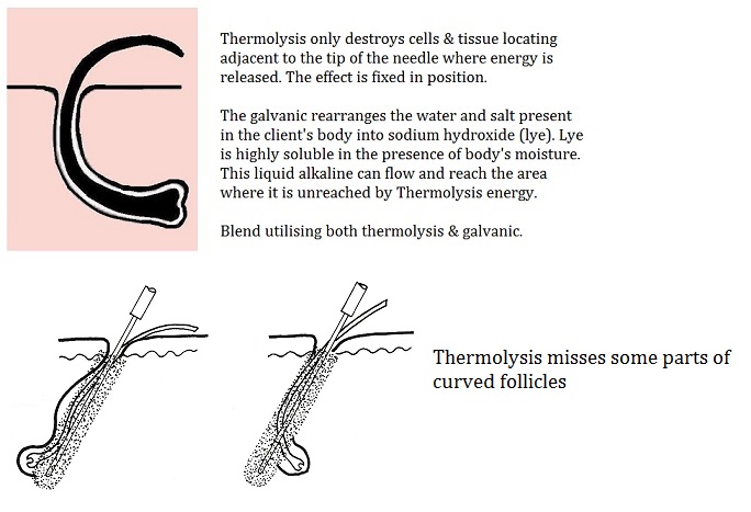 Beauty, Laser & Electrolysis Permanent Hair Removal: Electrolysis ...