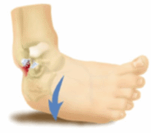 Common Injuries: The Ankle Sprain | Outdoor Quest