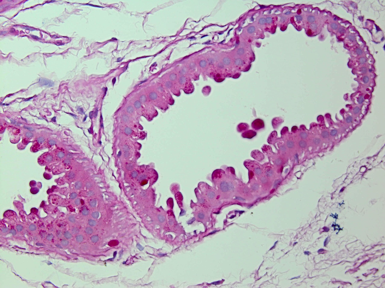 Lafora Disease - A Disease In Need Of A Cure