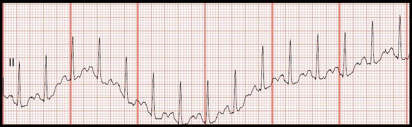 Float Nurse: Practice EKG Rhythm Strips 115