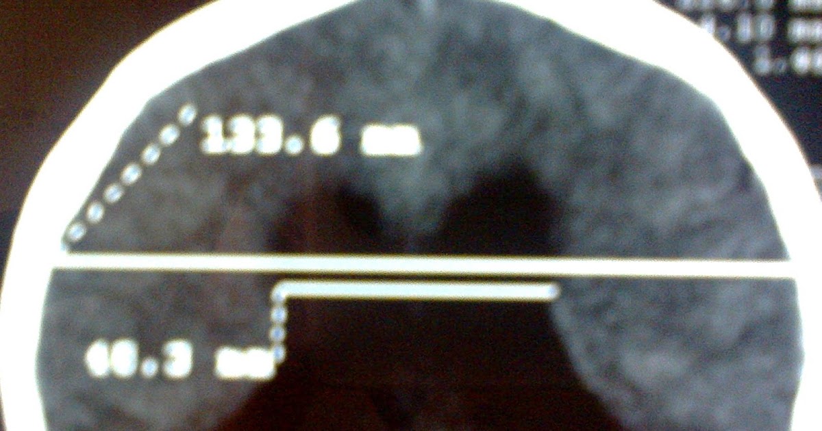 Neurocirugia Wilhen Gonce