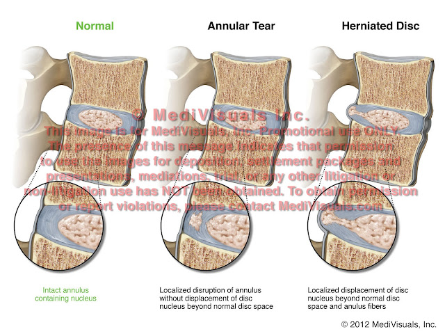 The Medical Legal Exhibit Expert Blog: Annular Tears and Fissures ...