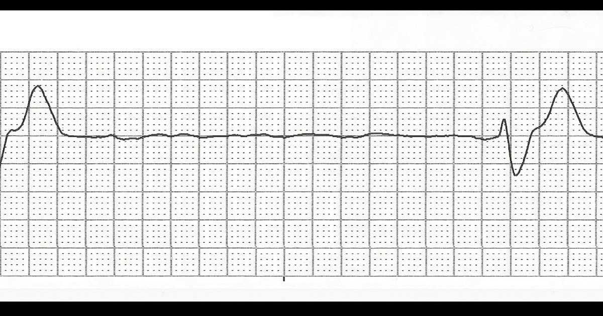 Agonal Rhythmasystole