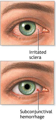(Arbeids)geneeskundige sprokkels: Rode ogen