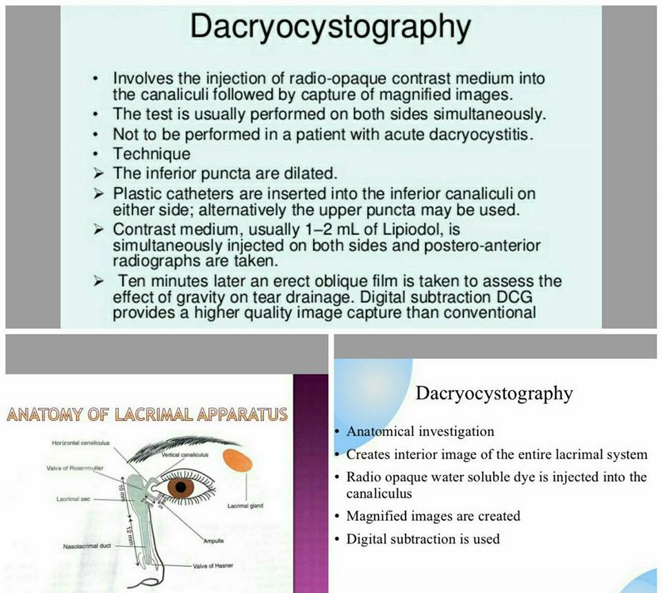 Technik Dacriografi ternyata masih di pakai - Seputar Kesehatan