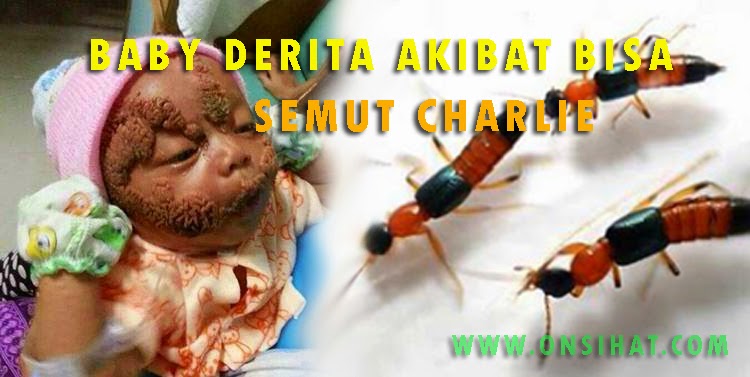 Bisa Racun Semut Charlie / Semut Kayap / Semut Tomcat | On Sihat