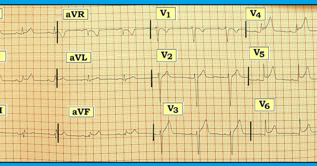 ECG Interpretation: ECG Blog #150 — Bridging vs Repolarization?