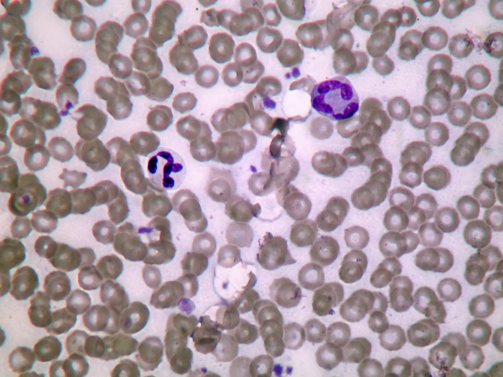 Tips & Cheap – N° 15-2014: CASO CLINICO CON EOSINOFILIA E BASOFILIA ...