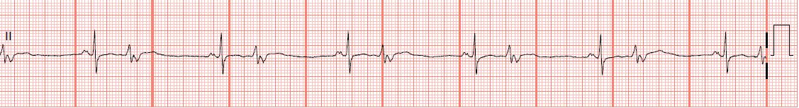 EKG Rhythm Strips: Bigeminy, Trigeminy, Quadrageminy