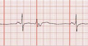 EKG Rhythm Strips: Bigeminy, Trigeminy, Quadrageminy