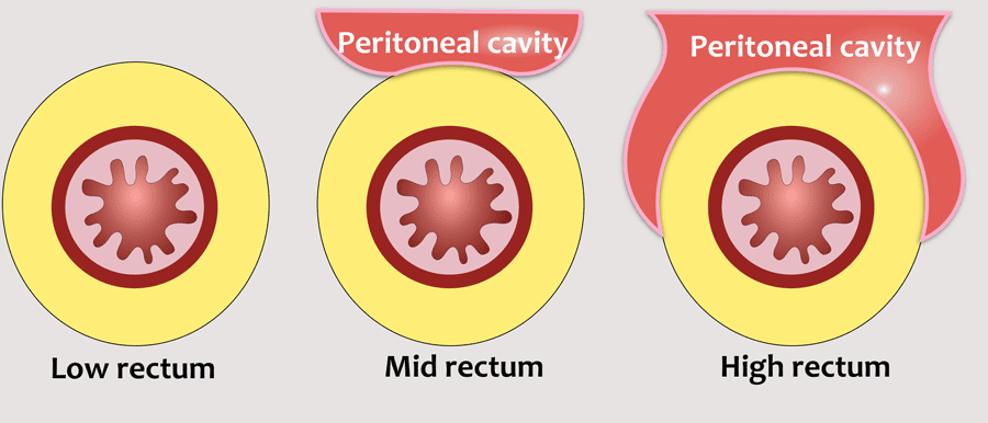 Radiotherapy Dictionary: Mesorectal fascia (MRF)
