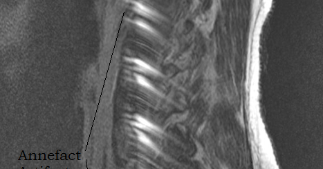 El Baúl Radiológico: ARTEFACTO DE ANEFACTO (Annefact Artifact in MRI ...