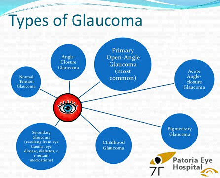 Types of glaucoma by Dr. Rahul Patoria